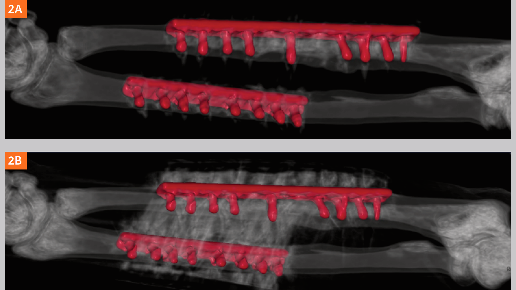 SOMATOM go.Top Experience with iMAR (iterative metal artifact reduction)