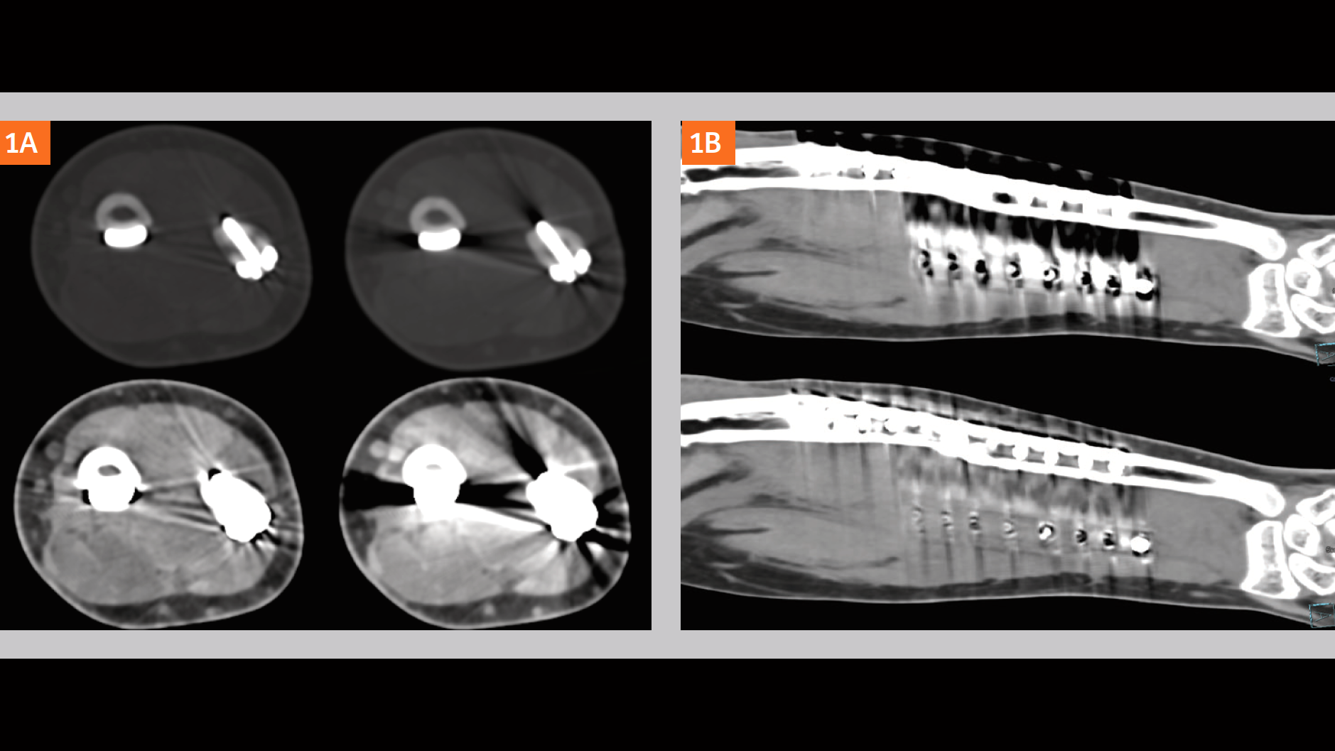 SOMATOM go.Top Experience with iMAR (iterative metal artifact reduction)