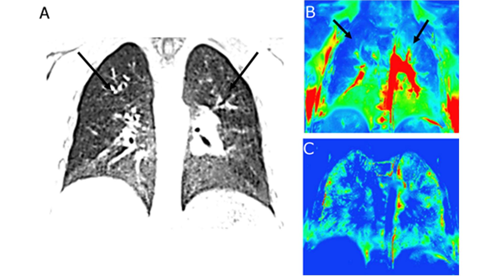 Lung MRI in Parenchymal Disease - Siemens Healthineers