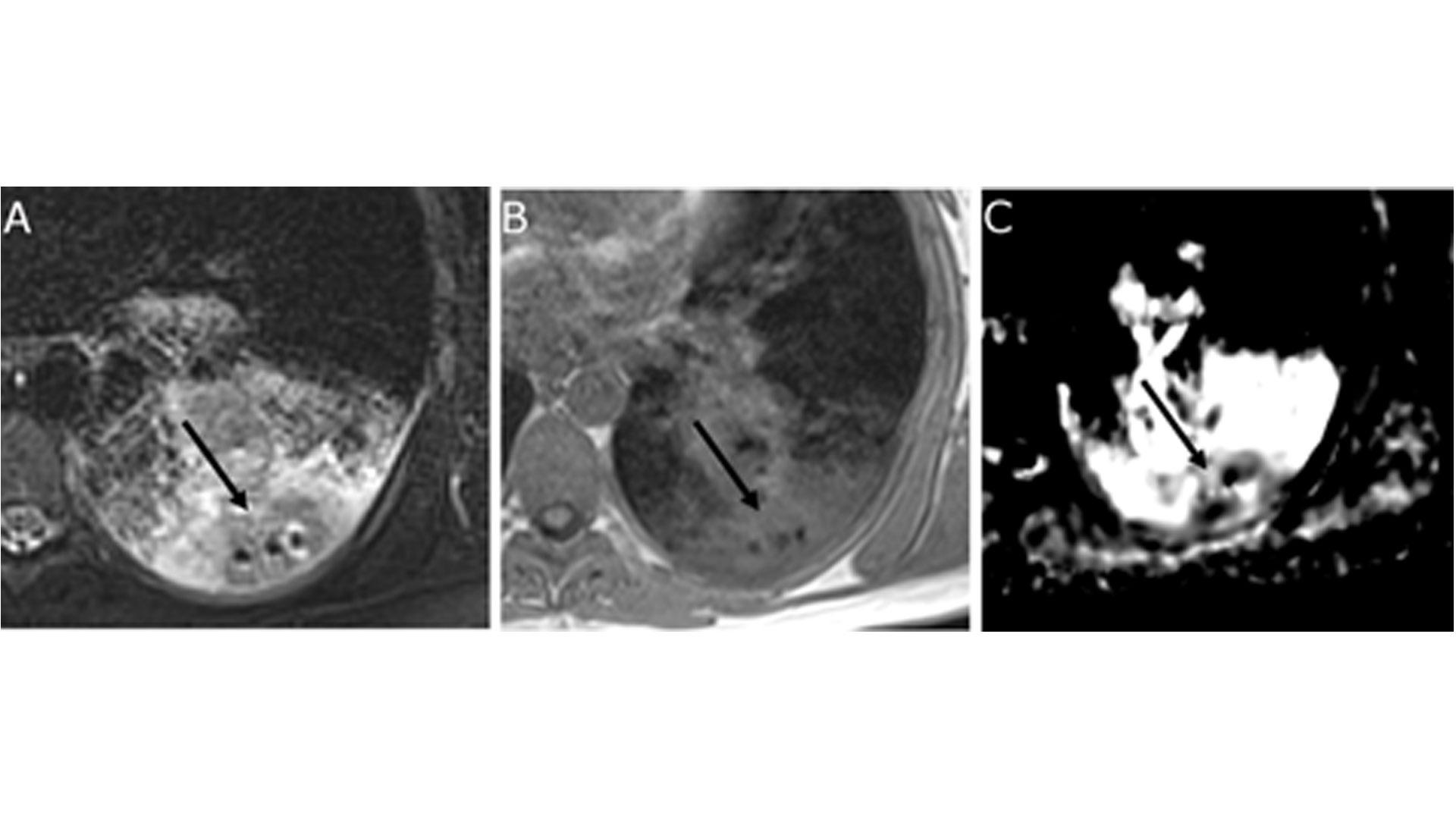 Lung MRI in Parenchymal Disease - Siemens Healthineers
