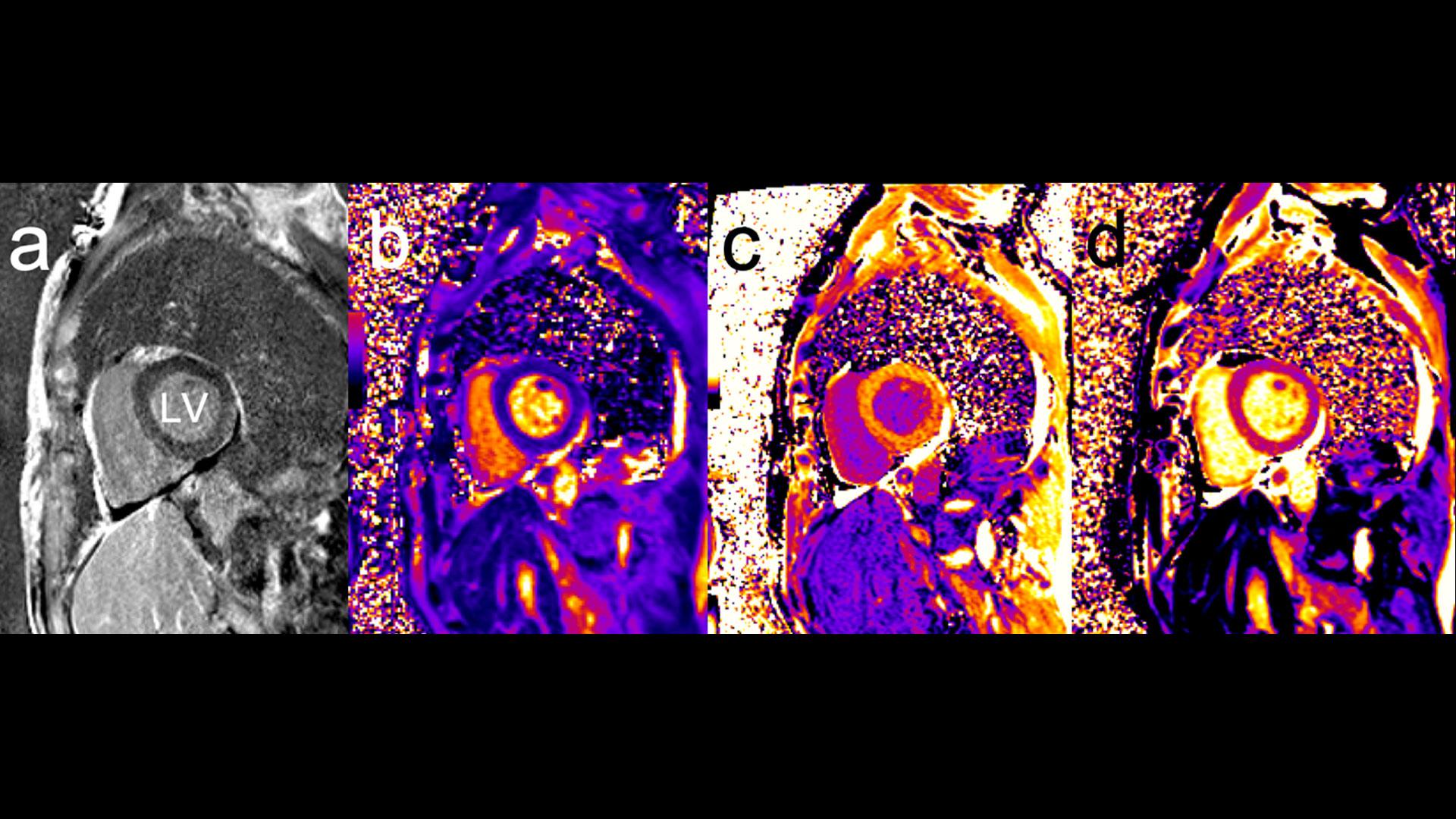 MR News & Stories - Siemens Healthineers