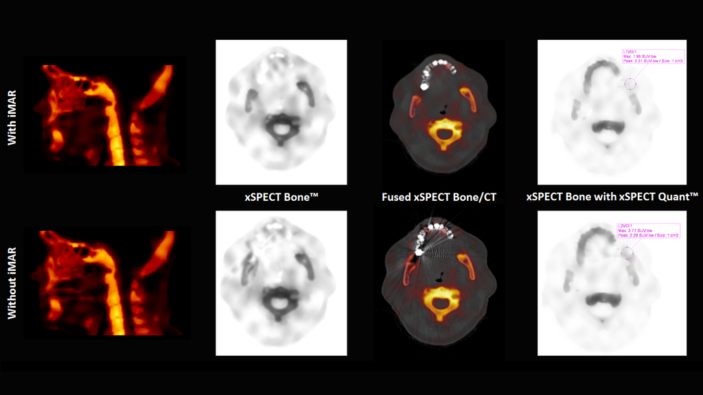 Imar Iterative Metal Artifact Reduction Siemens Healthineers Usa