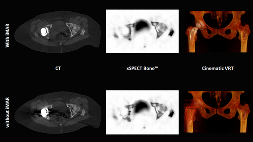 iMAR - Iterative Metal Artifact Reduction - Siemens Healthineers USA