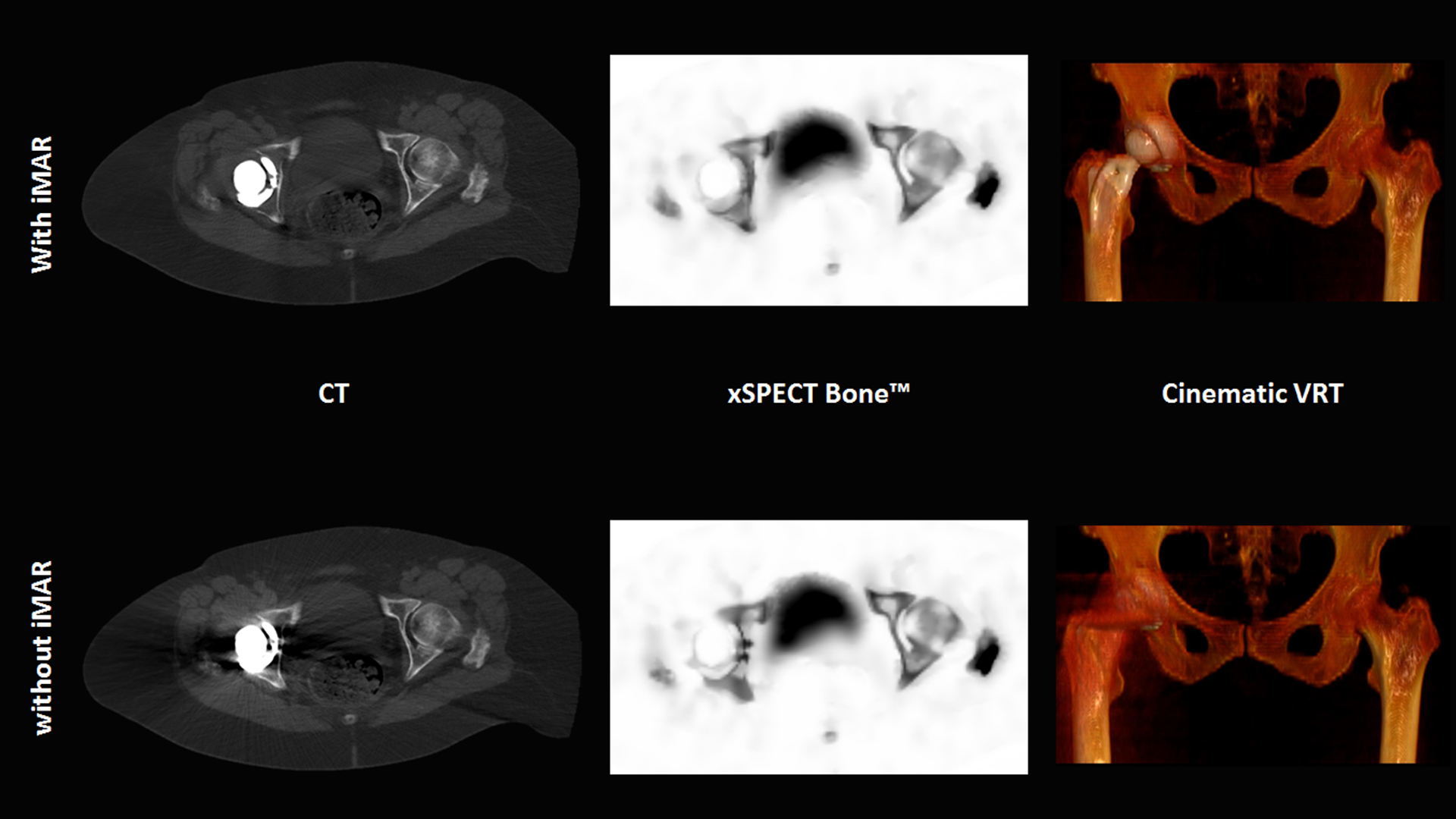 iMAR - Iterative Metal Artifact Reduction - Siemens Healthineers USA