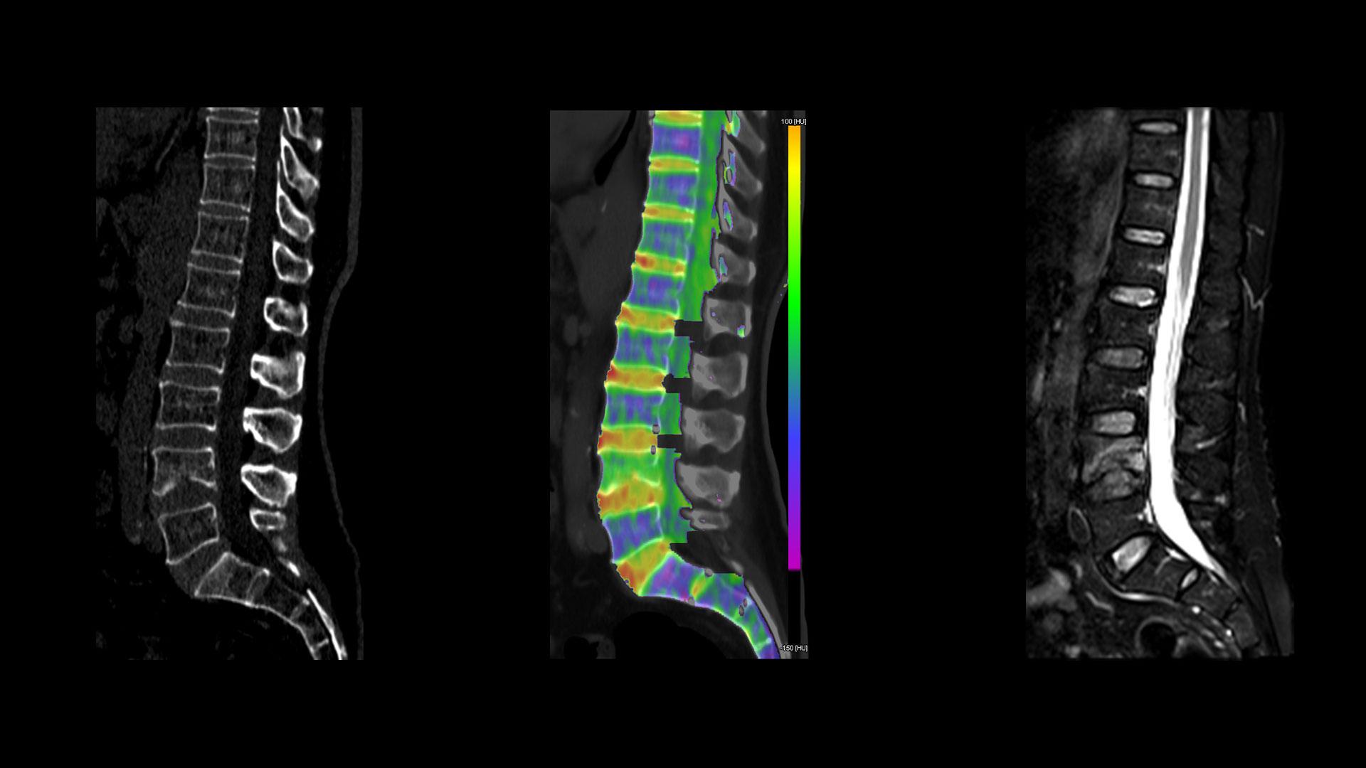 Vertebral Compression Fracture with Bone Marrow Edema - Siemens ...