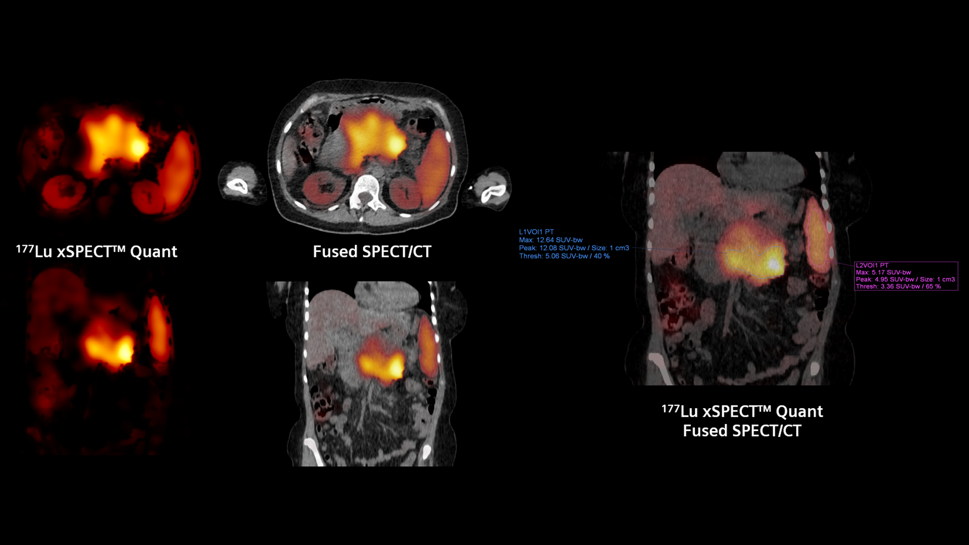 SAFIRE - Sinogram Affirmed Iterative Reconstruction - Siemens Healthineers
