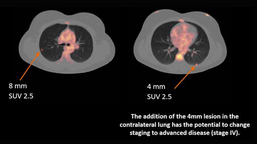 SAFIRE - Sinogram Affirmed Iterative Reconstruction - Siemens Healthineers