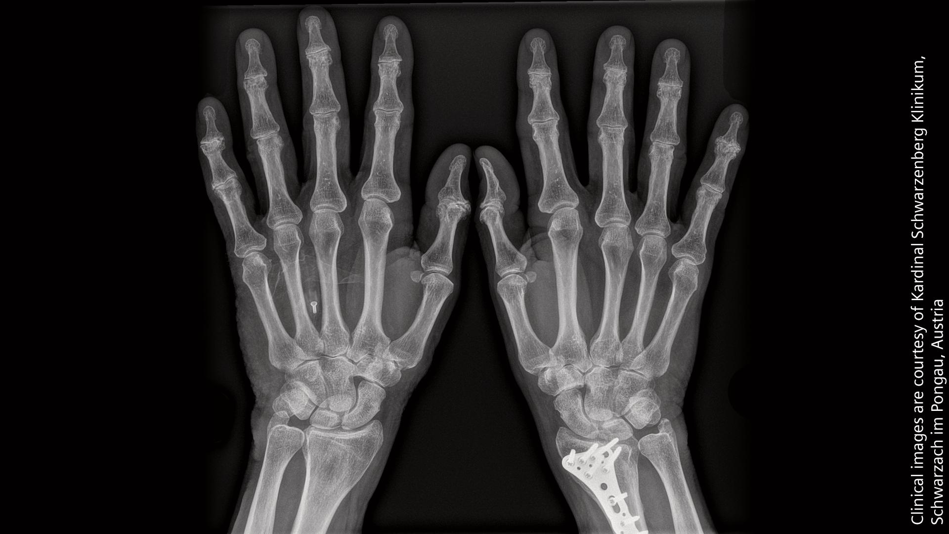 Multix Fusion Max - Digital Radiography Machine Siemens Healthineers Italia