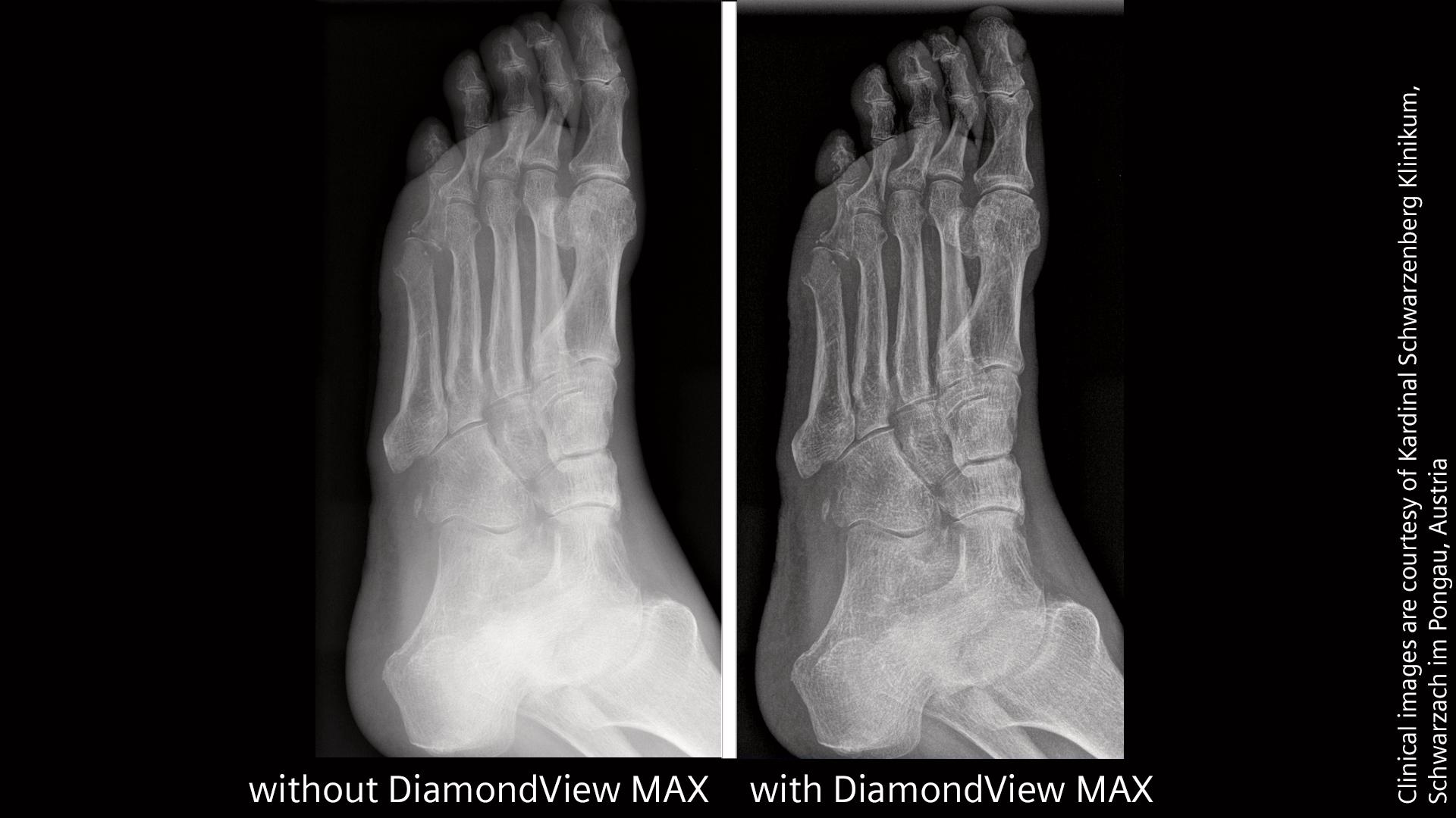 Multix Fusion Max - Digital Radiography Machine - Siemens Healthineers ...