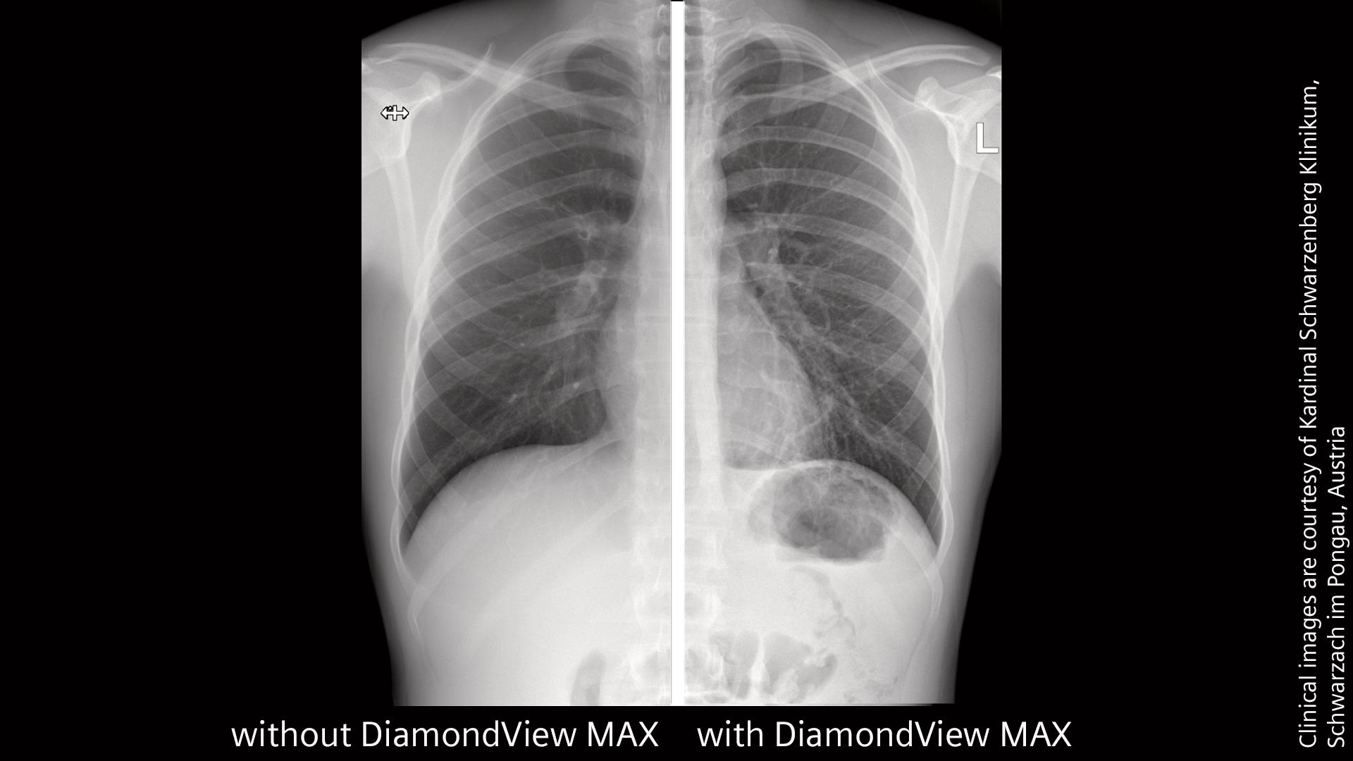 Multix Fusion Max - Digital Radiography Machine - Siemens Healthineers ...