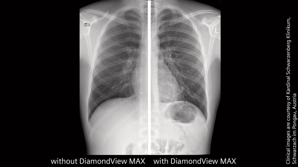 Multix Fusion Max - Digital Radiography Machine - Siemens Healthineers ...