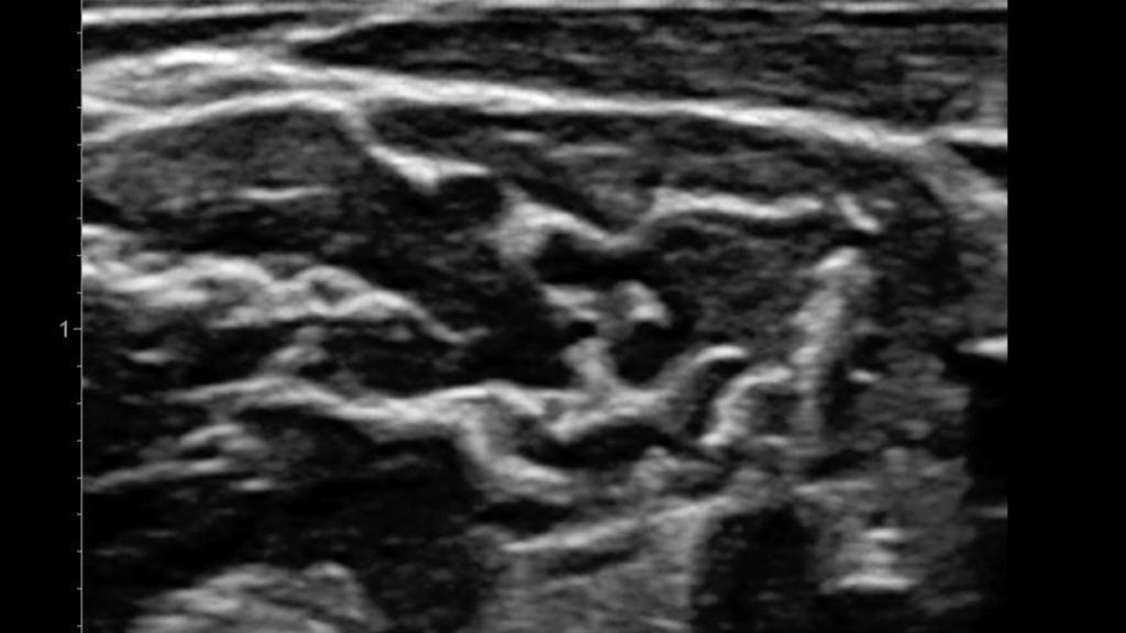 Wireless Ultrasound Transducers | ACUSON Freestyle - Siemens ...