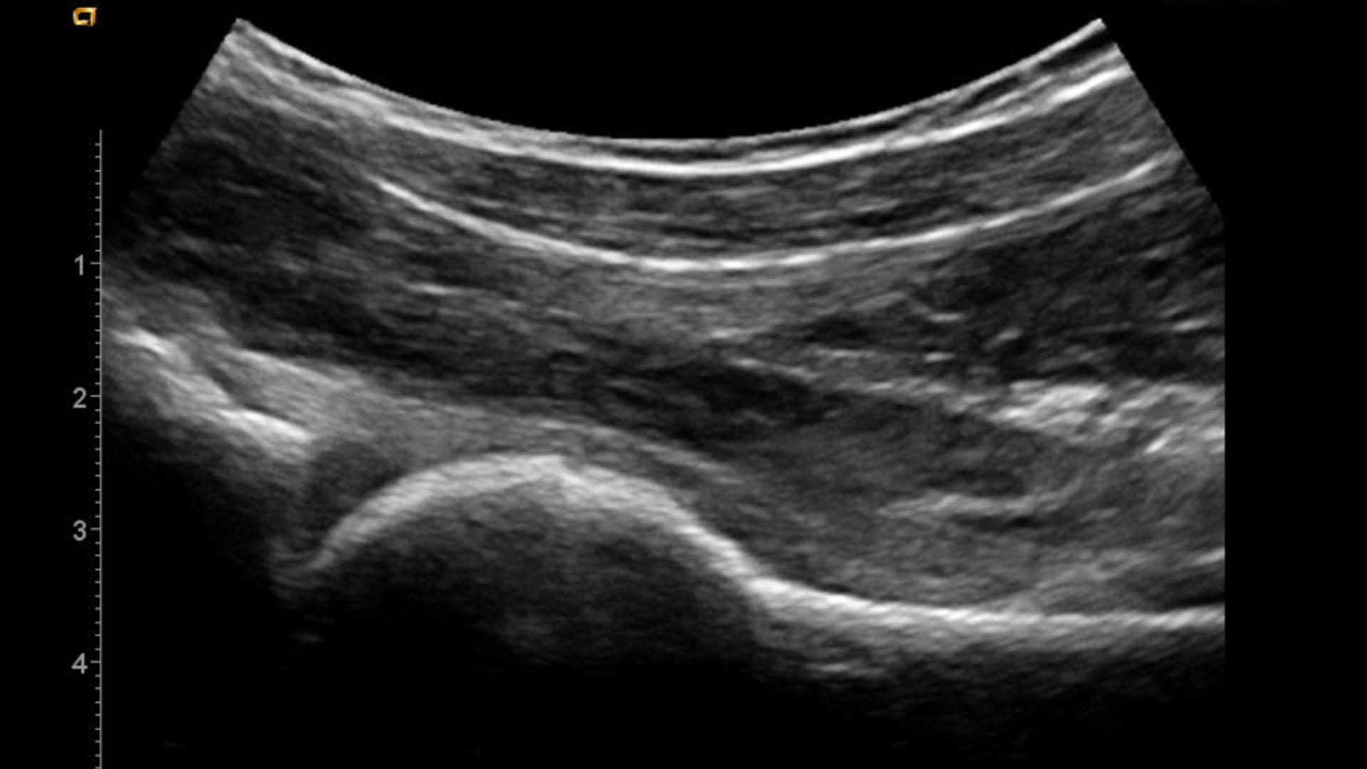 Wireless Ultrasound Transducers | ACUSON Freestyle - Siemens ...