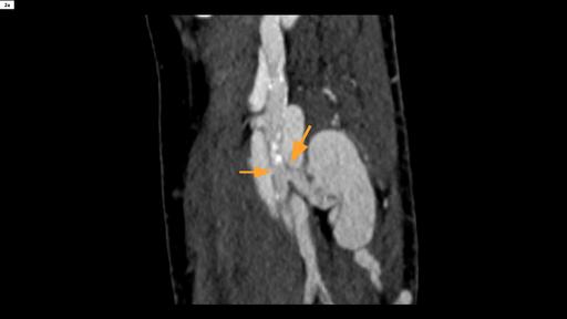Arteriovenous Malformation of the Left Lower Limb - Siemens ...