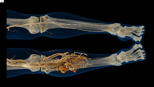 Arteriovenous Malformation of the Left Lower Limb - Siemens ...