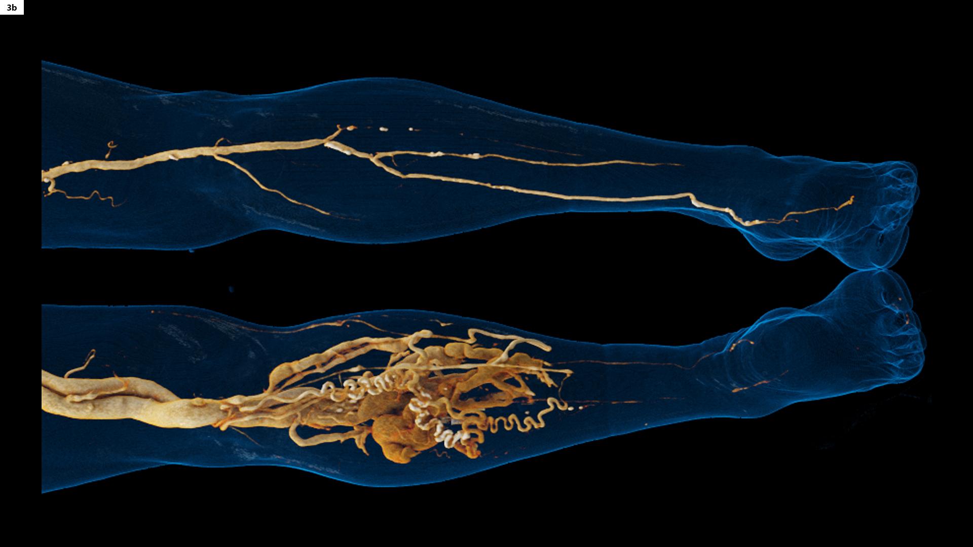 Arteriovenous Malformation of the Left Lower Limb - Siemens ...