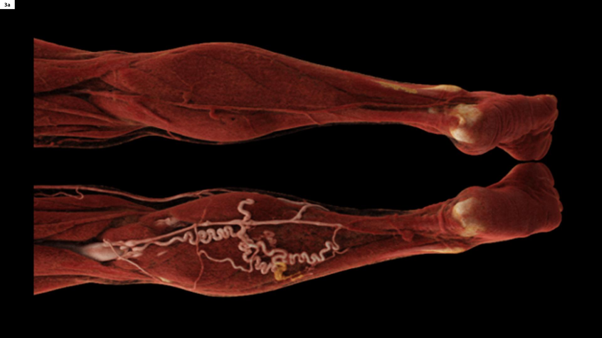 Arteriovenous Malformation of the Left Lower Limb - Siemens ...