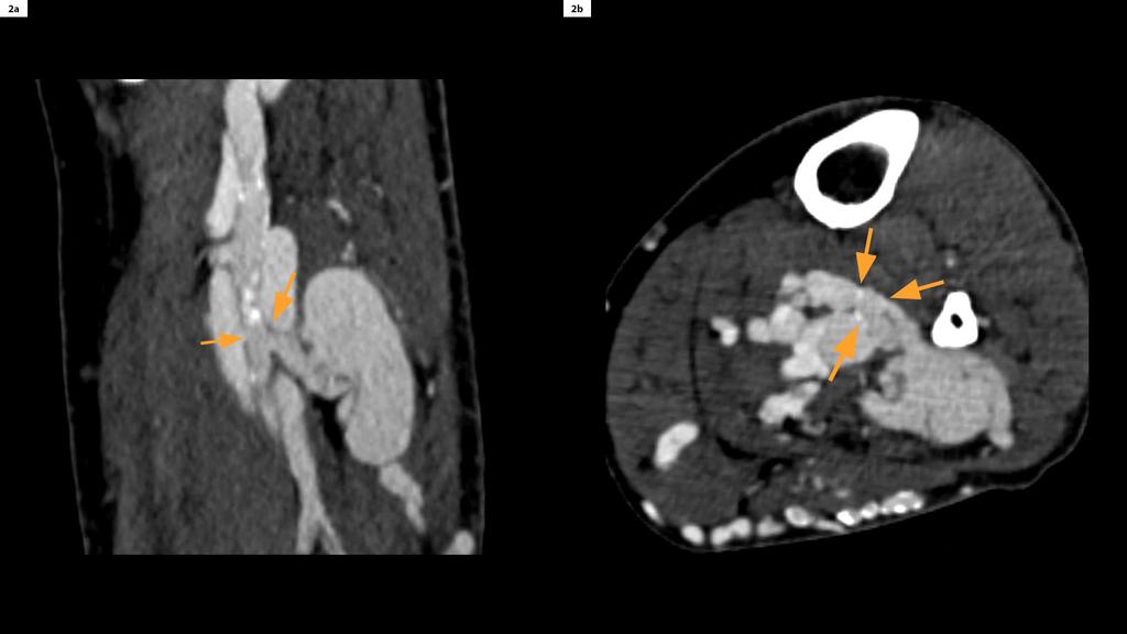 Arteriovenous Malformation of the Left Lower Limb - Siemens ...