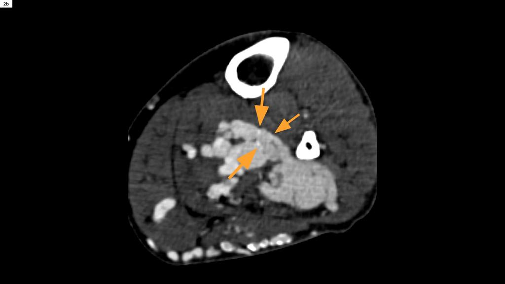 Arteriovenous Malformation of the Left Lower Limb - Siemens ...