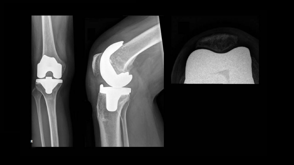 SPECT/CT delineation of patellar and femorotibial overload after knee ...