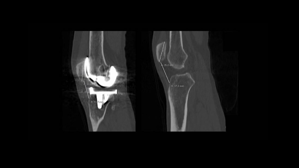 SPECT/CT delineation of patellar and femorotibial overload after knee ...