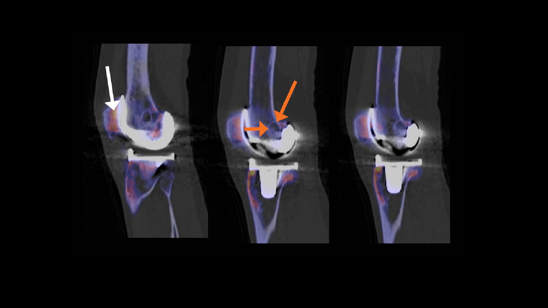SPECT/CT delineation of patellar and femorotibial overload after knee ...