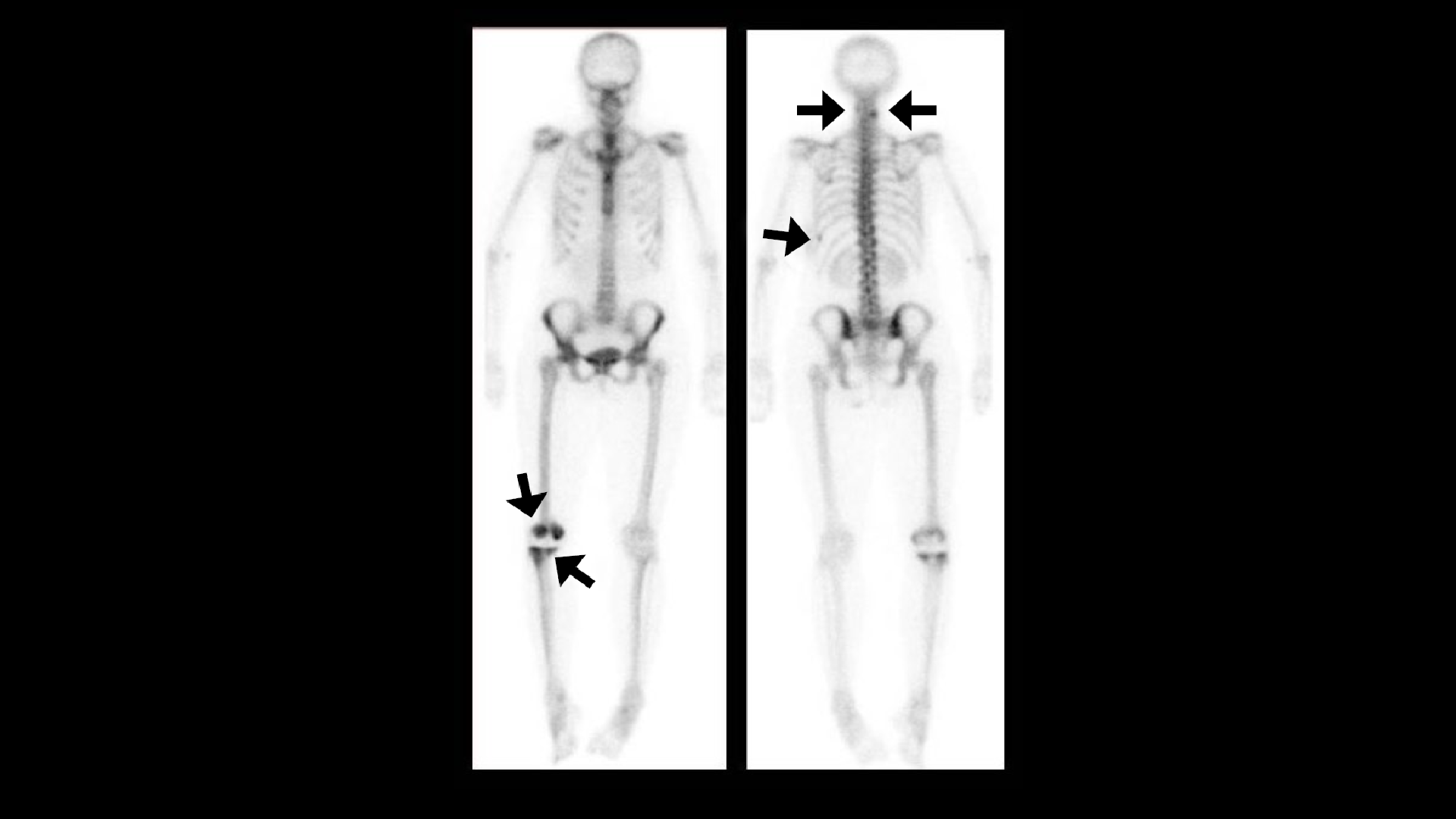 SPECT/CT delineation of patellar and femorotibial overload after knee ...