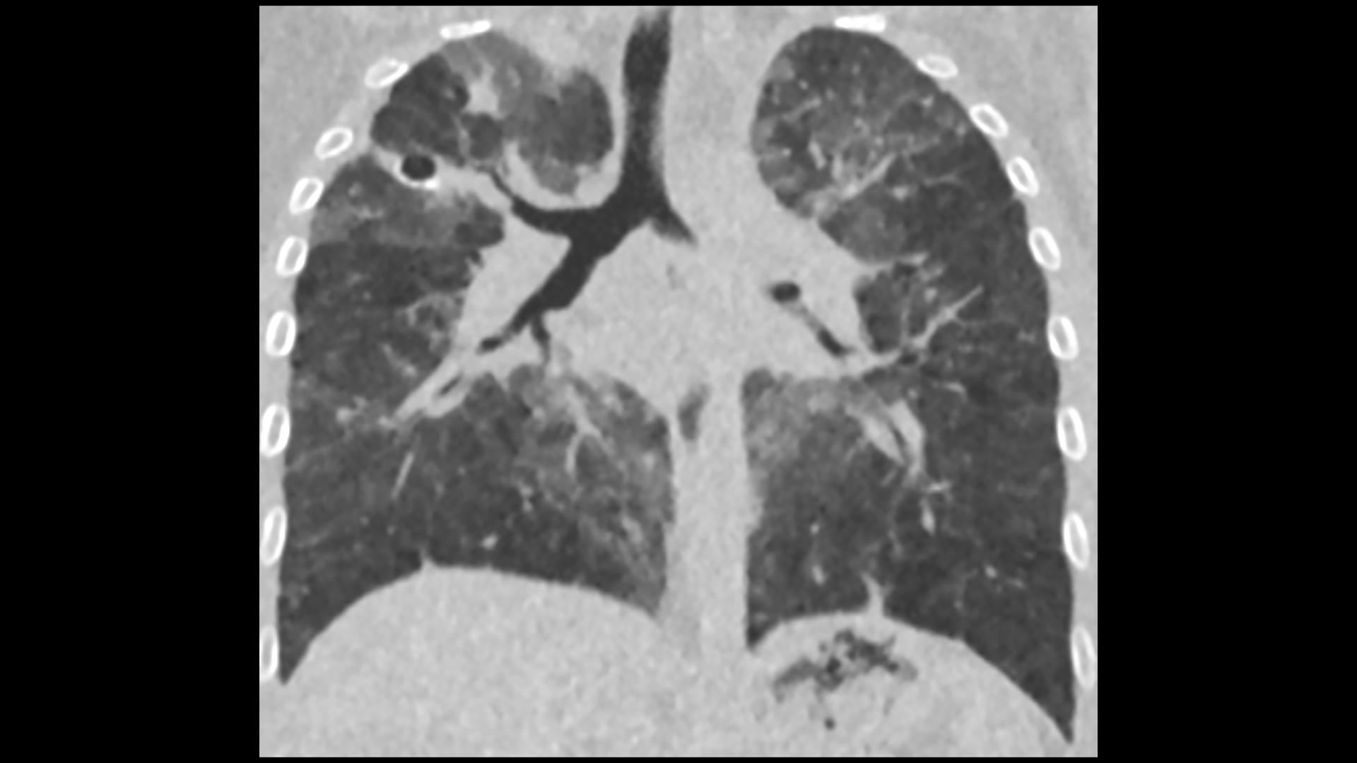 Pediatric Primary Tuberculosis Complicated by a Bronchopneumonia ...