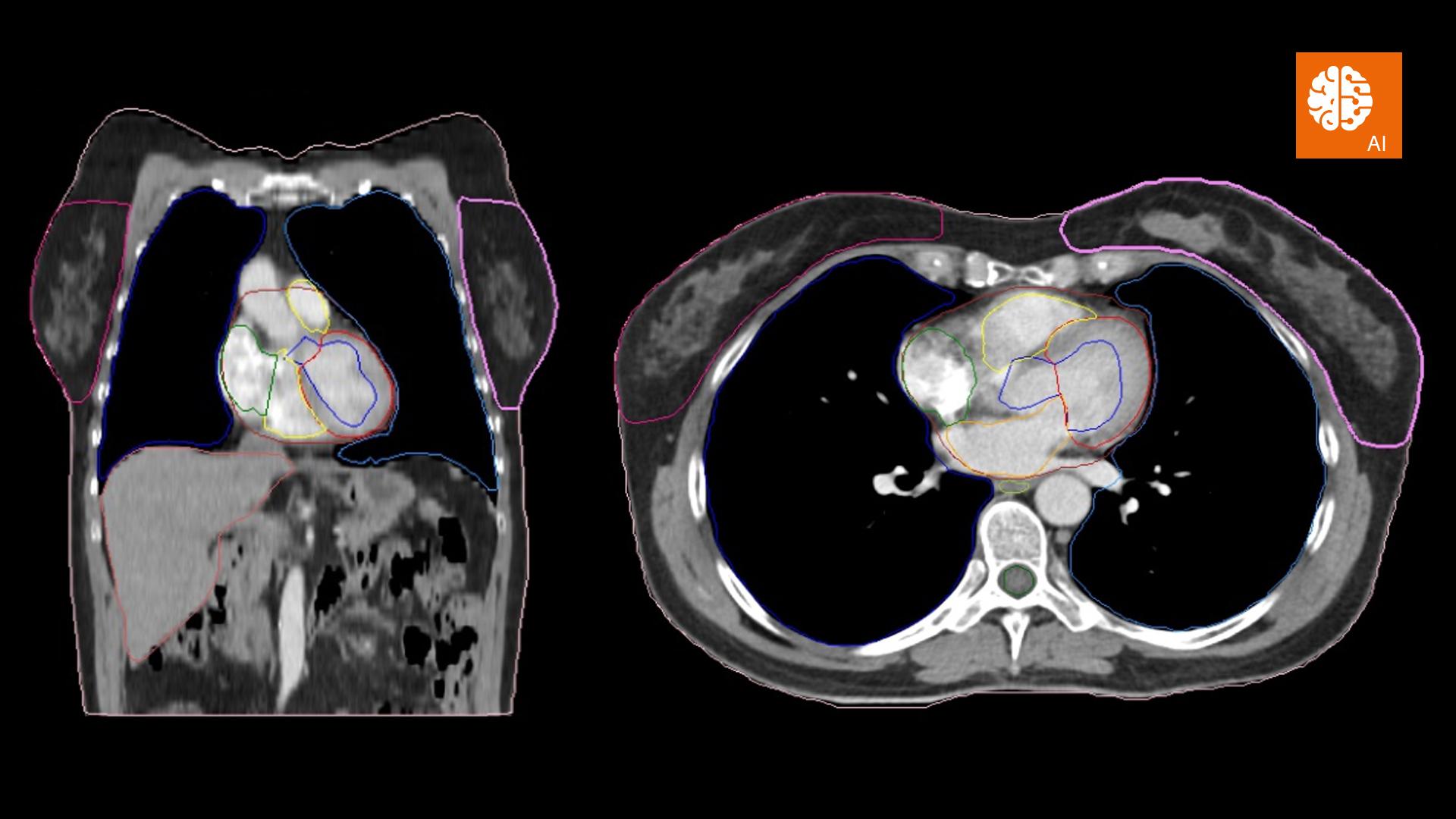 SOMATOM go.Open Pro - Siemens Healthineers
