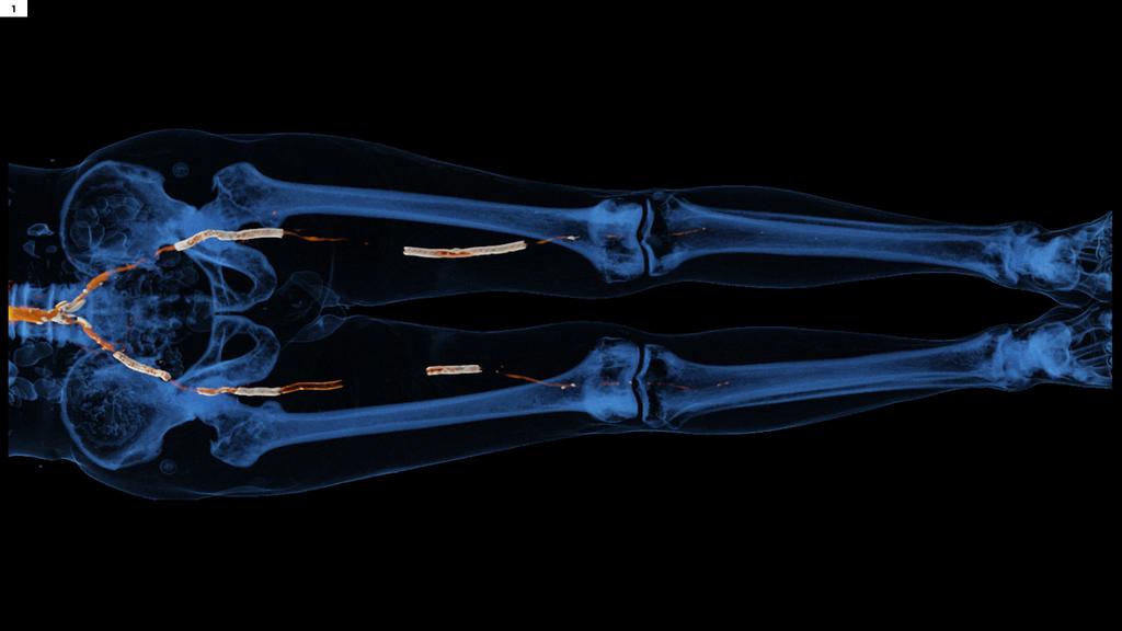 In-stent Restenoses & Occlusion – A Follow-up of Multiple Peripheral ...