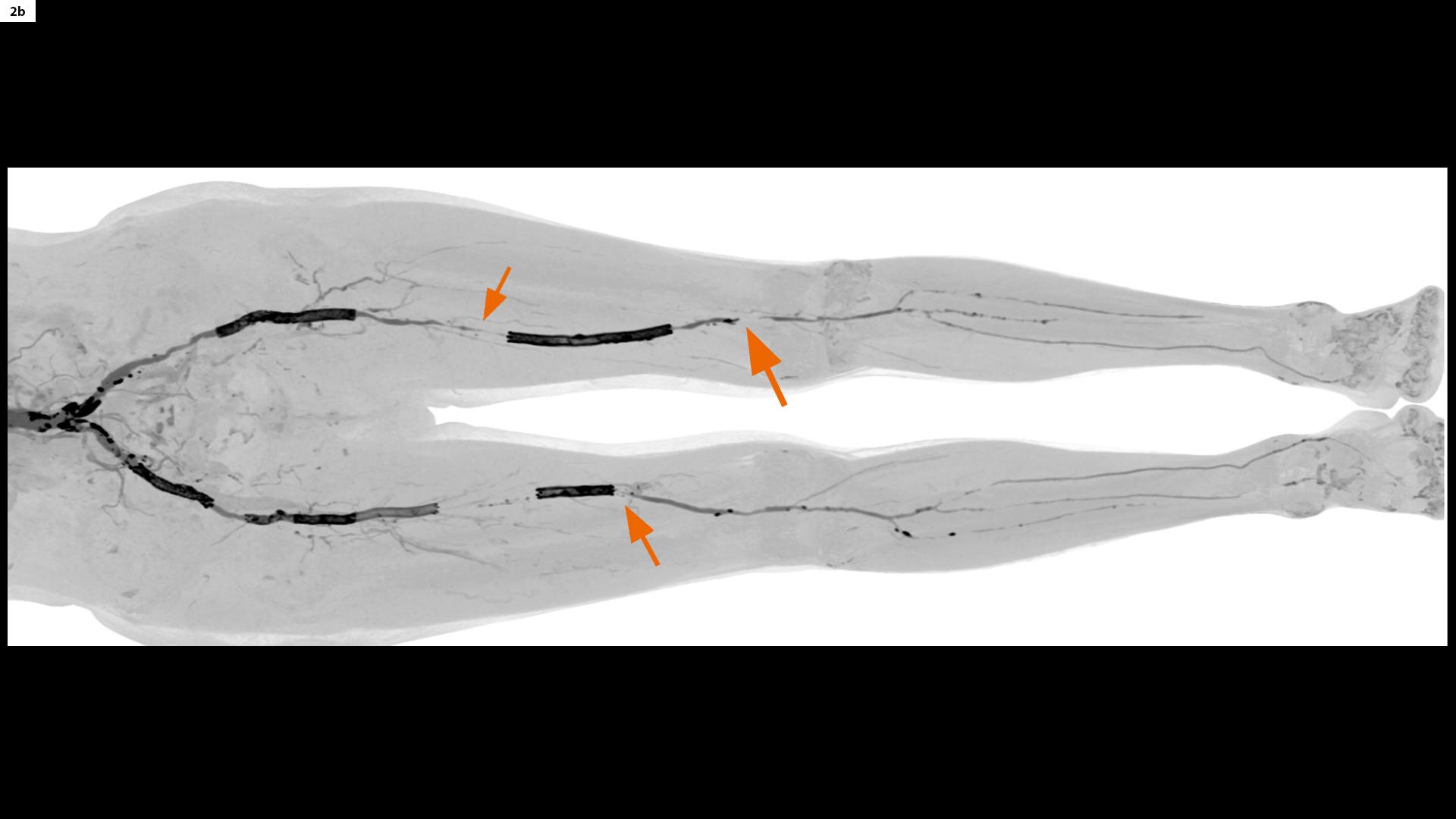 In-stent Restenoses and Occlusion – a follow-up of Multiple Peripheral ...