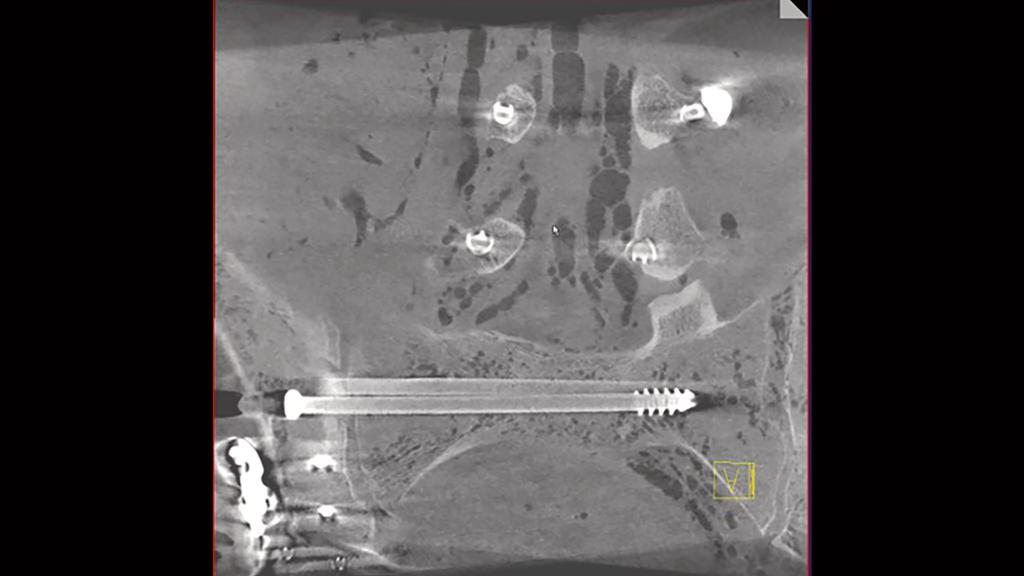 Intraoperative 3D imaging in orthopedic trauma surgery - Siemens ...