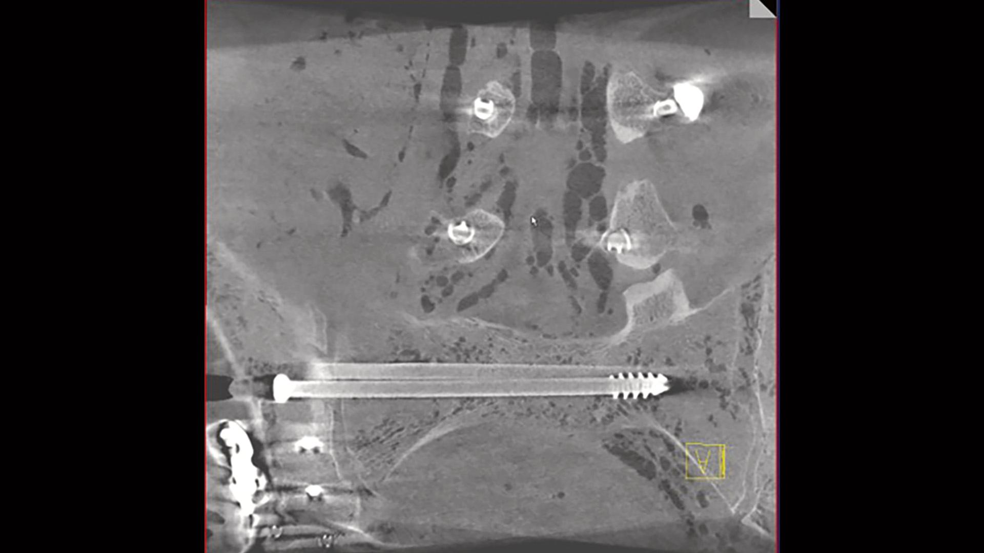 Intraoperative 3D imaging in orthopedic trauma surgery - Siemens ...