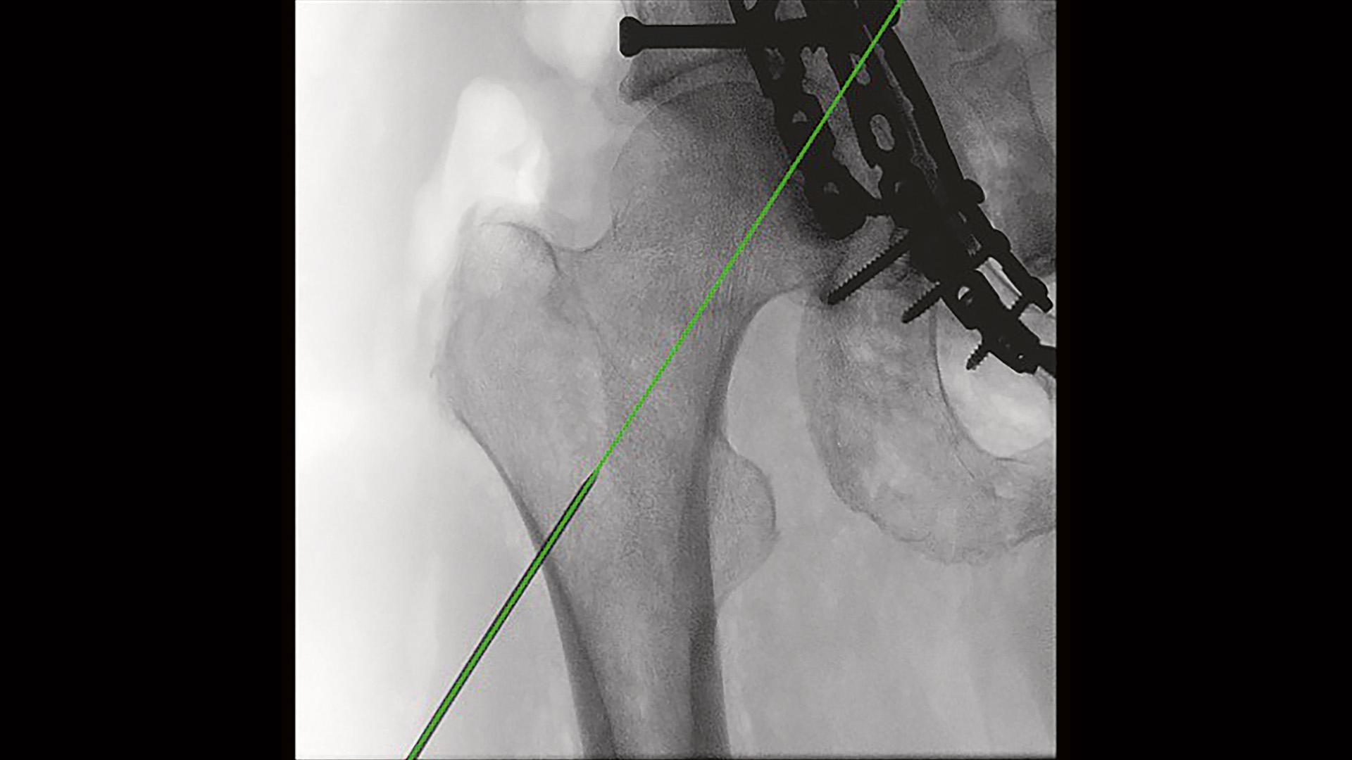 Intraoperative 3D imaging in orthopedic trauma surgery - Siemens ...