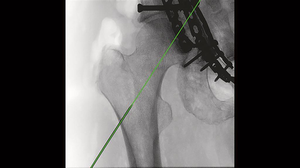 Intraoperative 3D imaging in orthopedic trauma surgery - Siemens ...