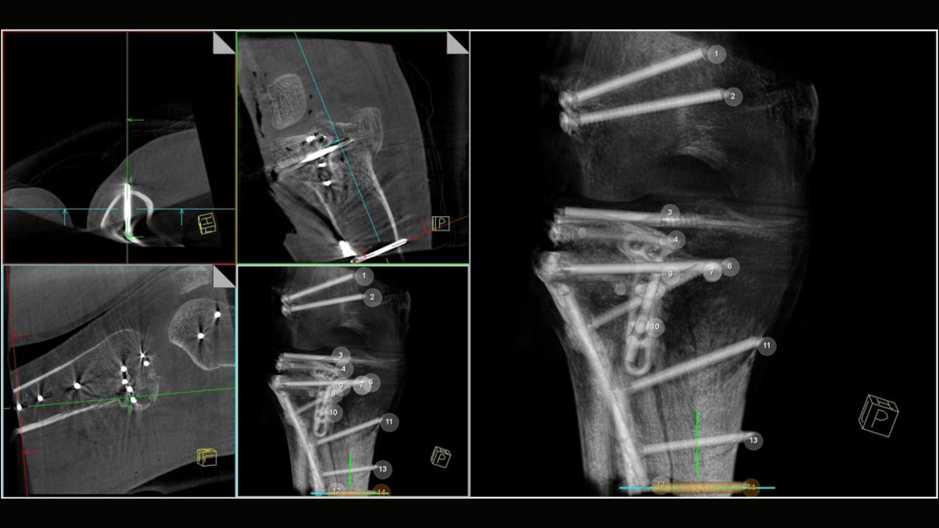 Intraoperative 3D imaging in orthopedic trauma surgery - Siemens ...