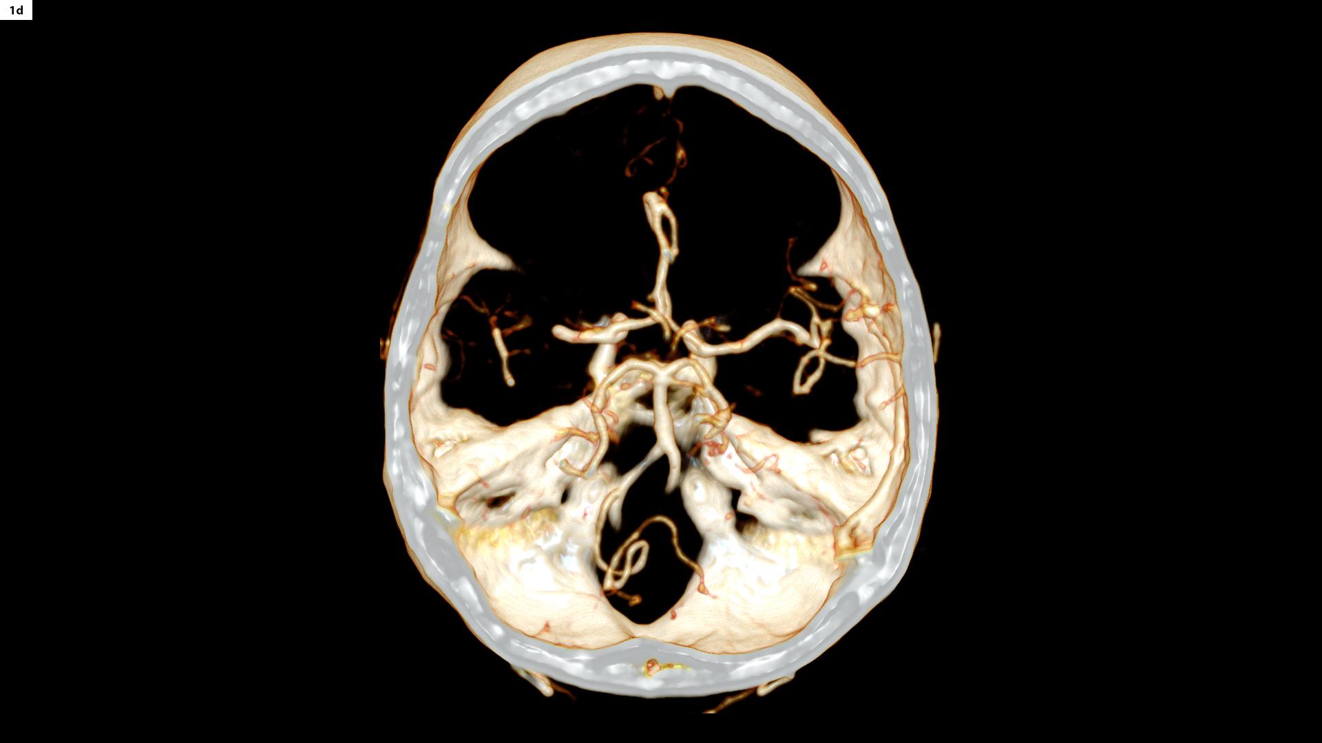 Acute Ischemic Stroke – Cerebral Perfusion prior to and after Treatment