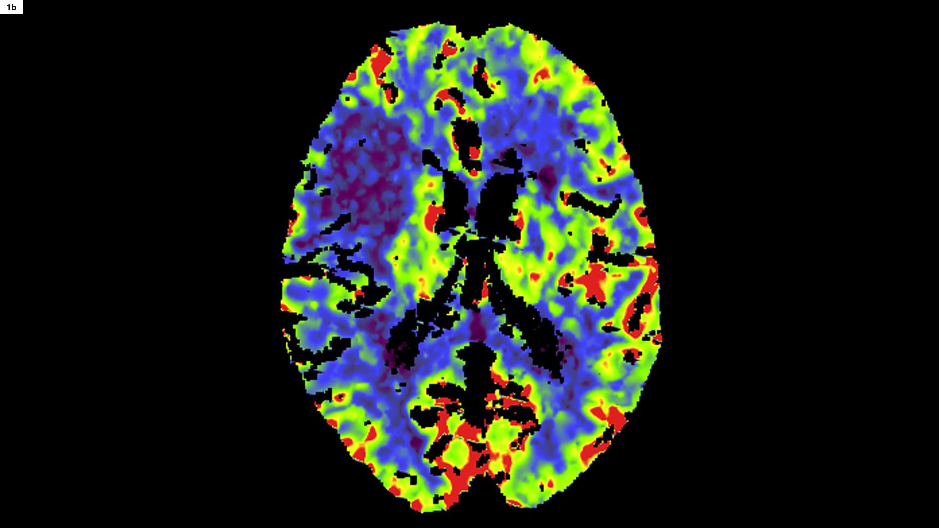 Acute Ischemic Stroke – Cerebral Perfusion prior to and after Treatment