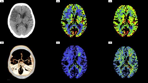 Acute Ischemic Stroke – Cerebral Perfusion prior to and after Treatment