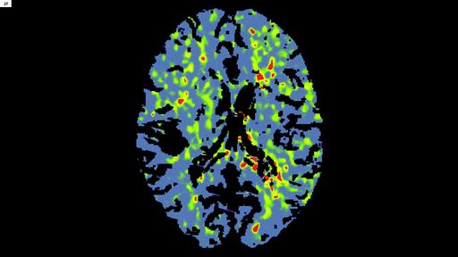 Acute Ischemic Stroke – Cerebral Perfusion prior to and after Treatment