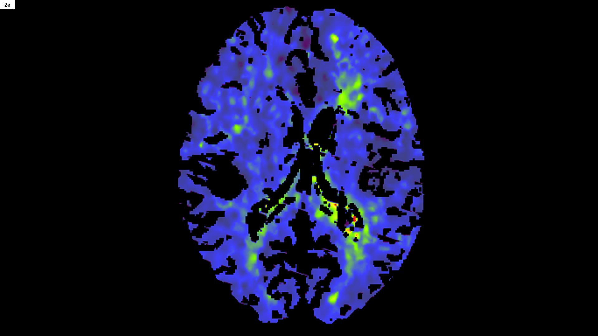 Acute Ischemic Stroke – Cerebral Perfusion prior to and after Treatment