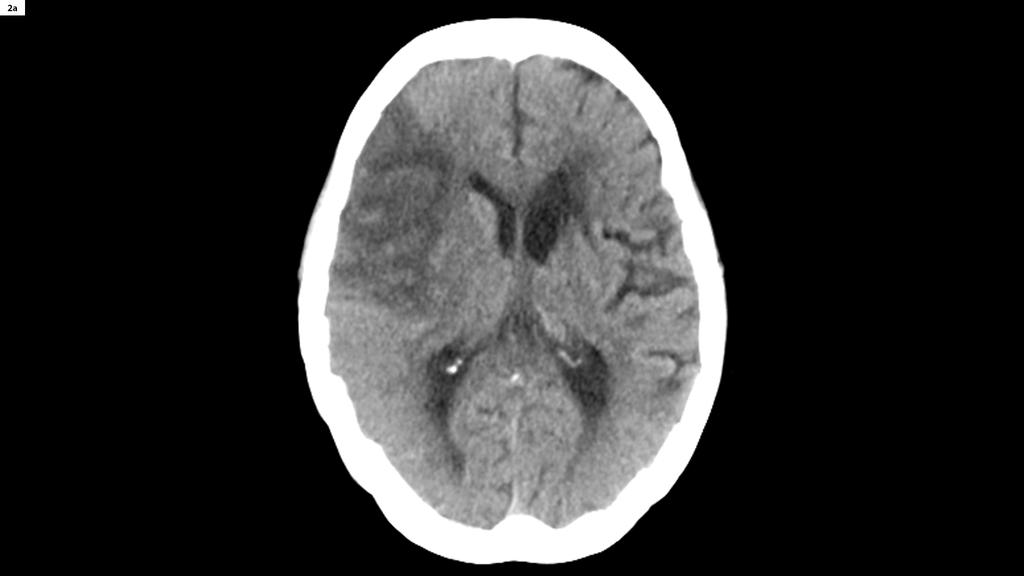 Acute Ischemic Stroke – Cerebral Perfusion prior to and after Treatment