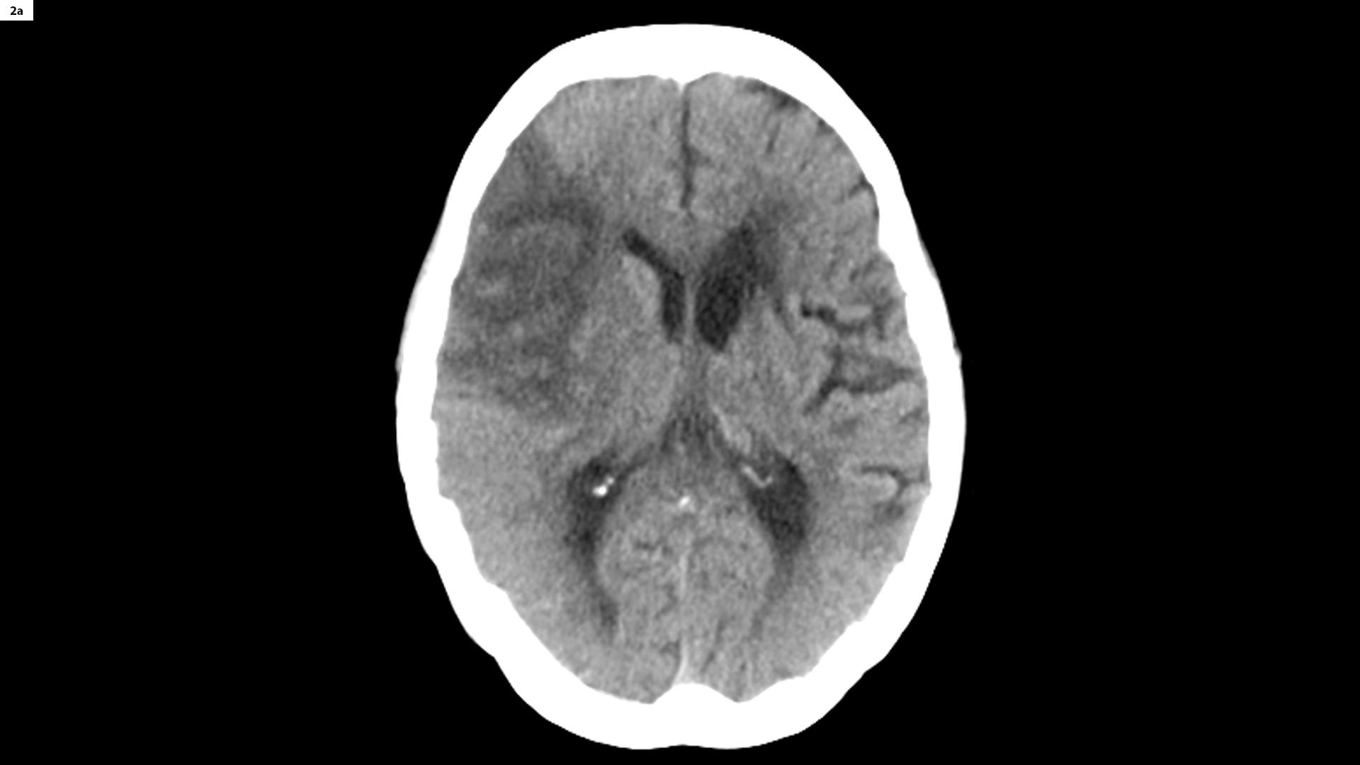 Acute Ischemic Stroke – Cerebral Perfusion prior to and after Treatment