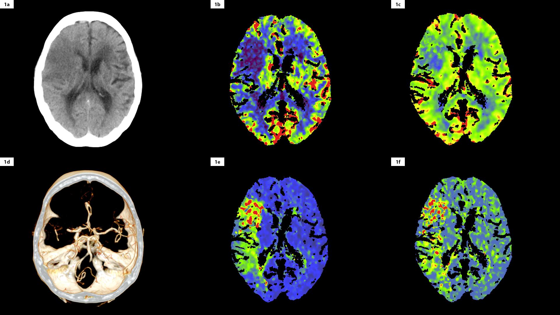 Acute Ischemic Stroke – Cerebral Perfusion prior to and after Treatment
