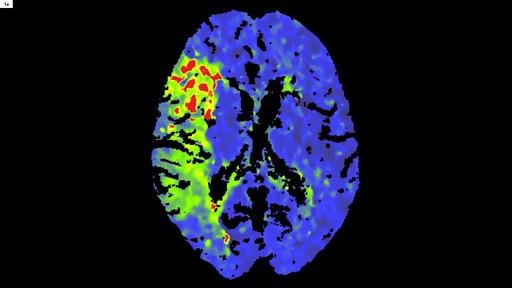Acute Ischemic Stroke – Cerebral Perfusion prior to and after Treatment