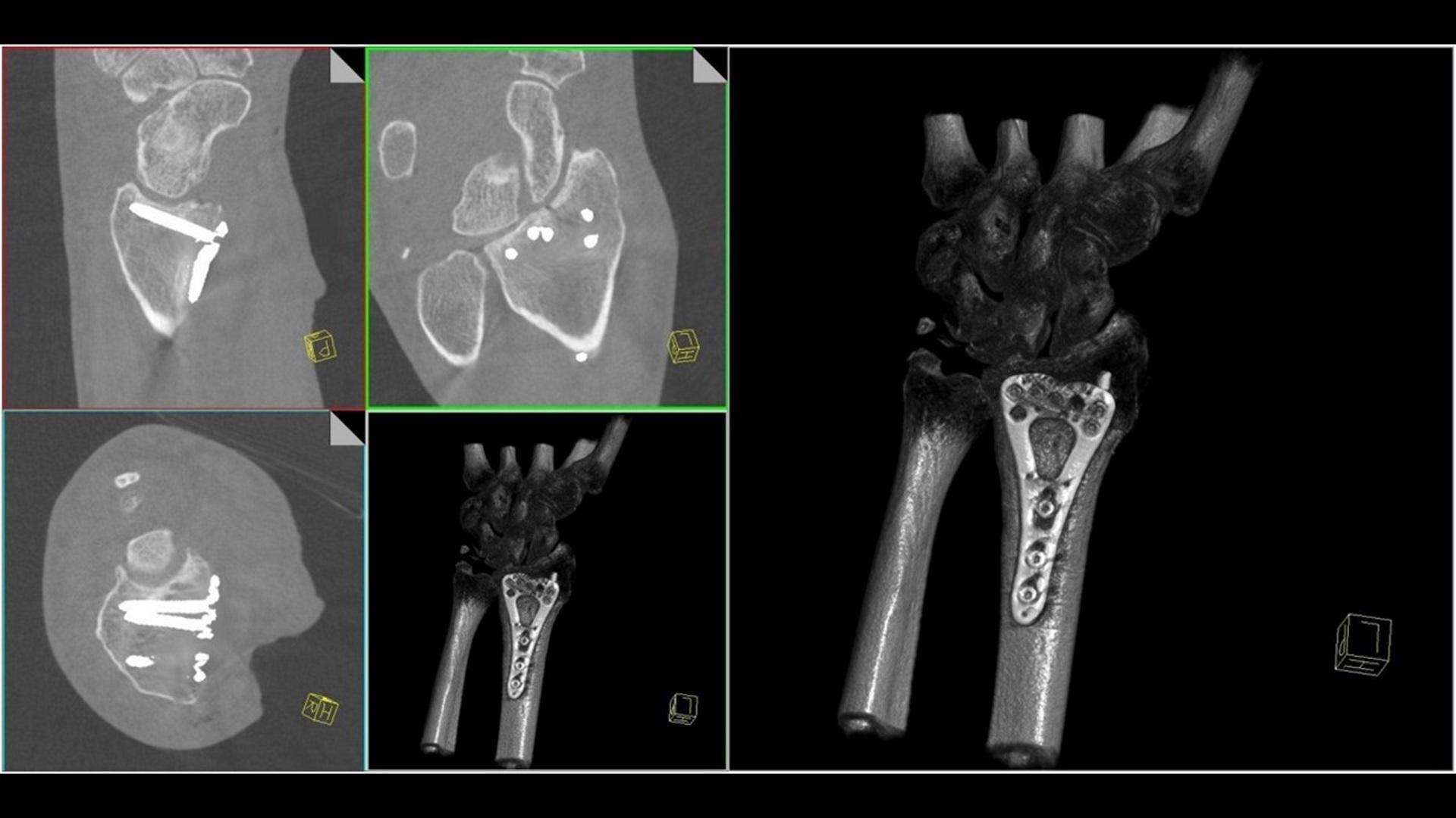 Mobile C-arm machine - Cios Spin - Siemens Healthineers Canada