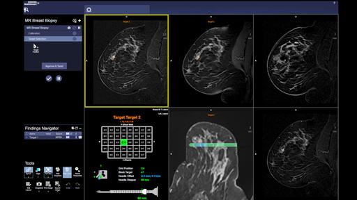 Breast MRI