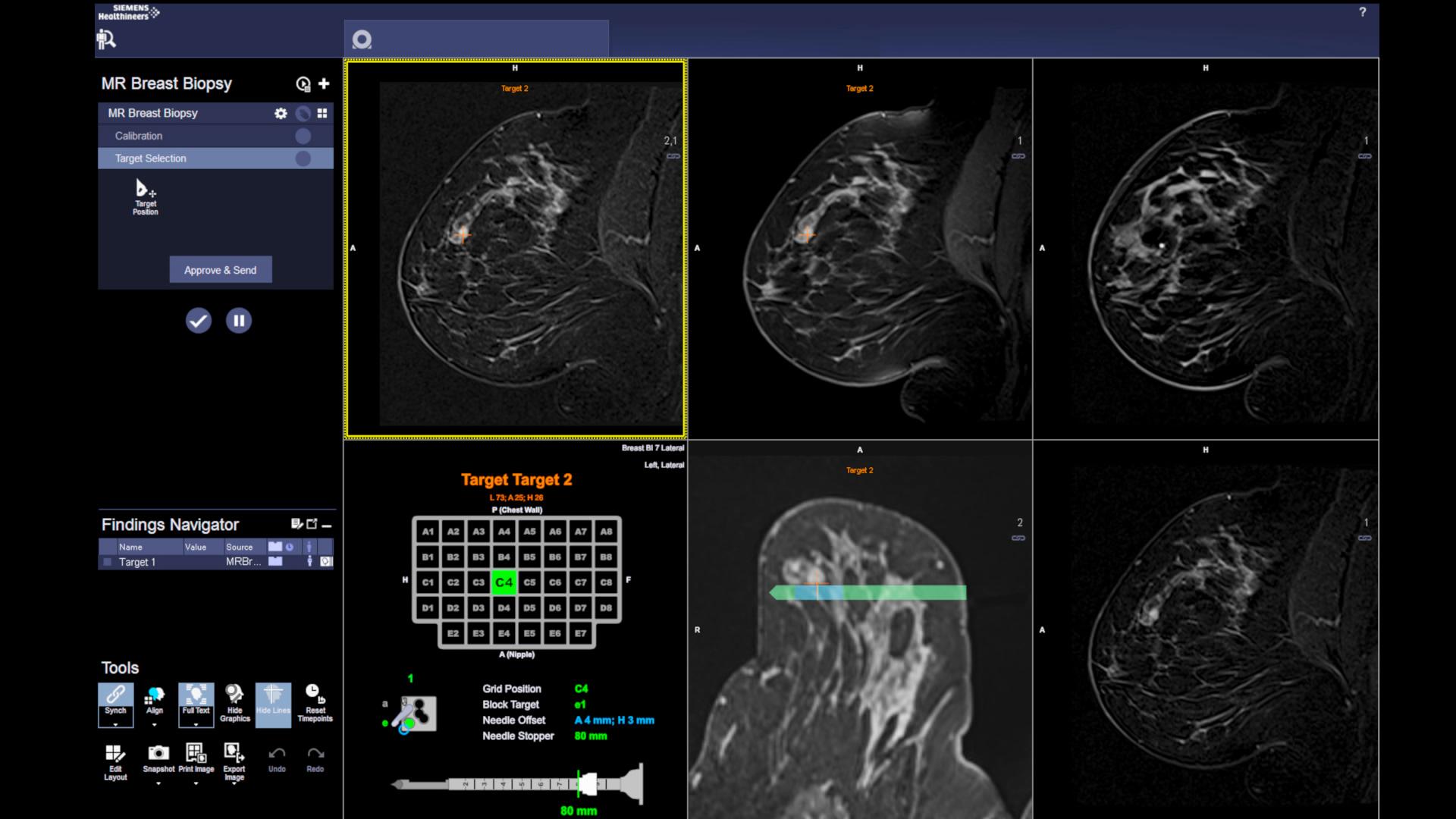 Breast MRI - Siemens Healthineers USA