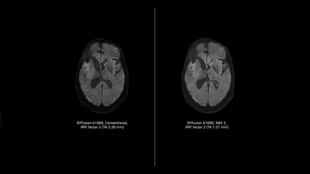 Simultaneous Multi-Slice - Siemens Healthineers