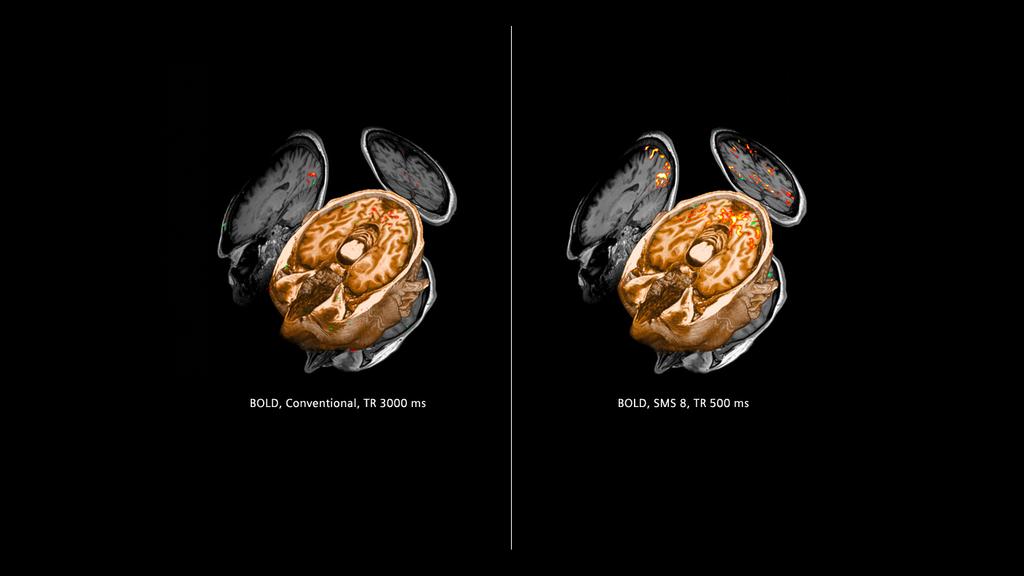 Simultaneous Multi-Slice - Siemens Healthineers